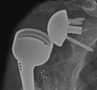 UW Shoulder and Elbow Academy: Reverse total shoulder - dislocations ...