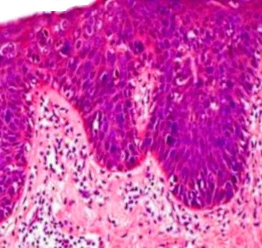 Dermatopathology Case 119
