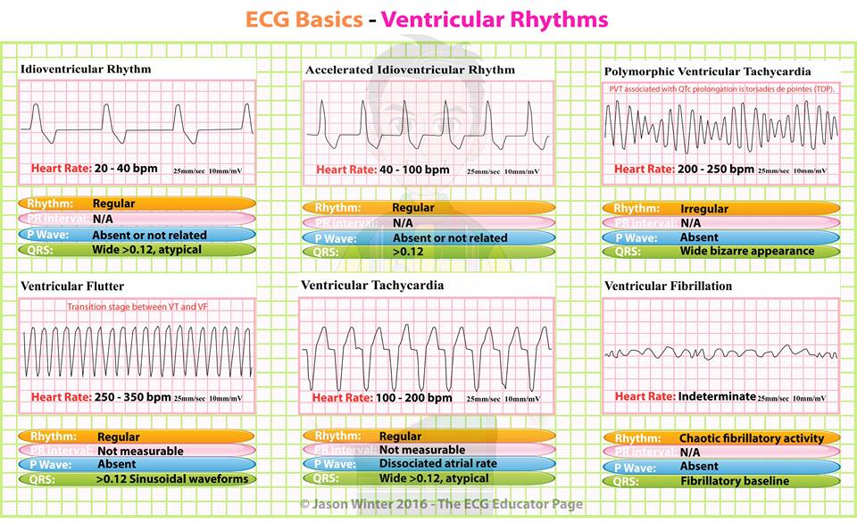 SAYANGI JANTUNG KITA: Gambar EKG & JANTUNG