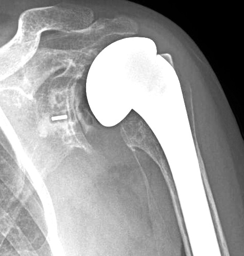 UW Shoulder and Elbow Academy: Total shoulder - tuberosity fracture and ...