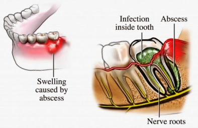 Ask.DentistMY 牙牙学医: Ask.Dentist: What is death tooth? How to save a ...