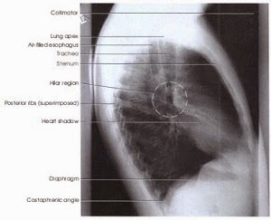 LATERAL CHEST X-RAY | ERECT | Radiology Basics | Radtechonduty