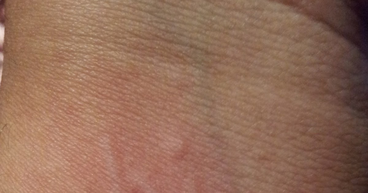 Allergic Reaction To Sulfa Drugs Rash : Skin And Hair_ ~ Testy State