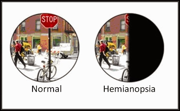 Stronger After Stroke Blog (THE STROKE RECOVERY BLOG): Hemianopsia ...