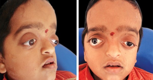 Hello USA: frontal bossing