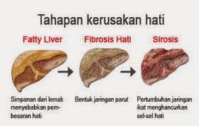 Penyakit Hati