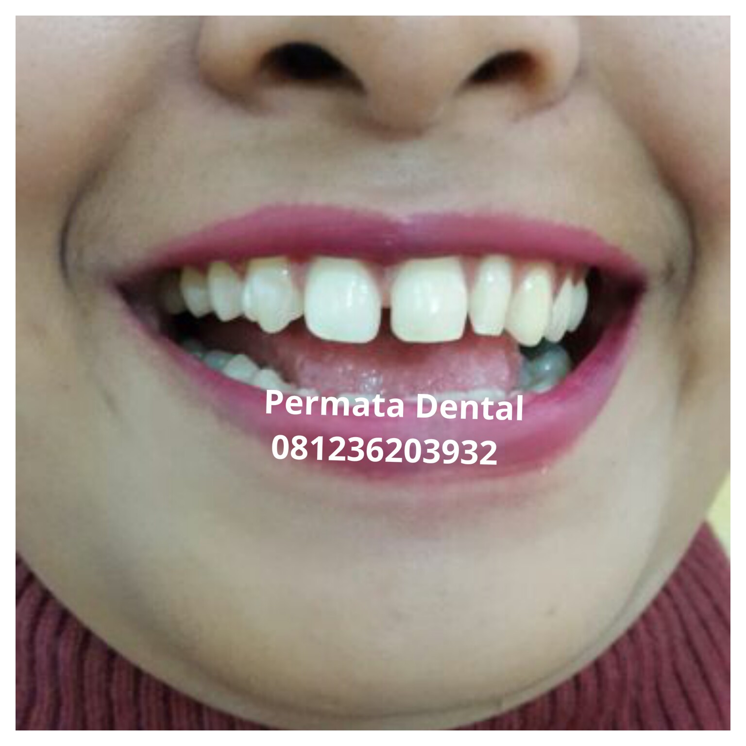 DOKTER GIGI BALI: Veneer Gigi | Samsung Gigi