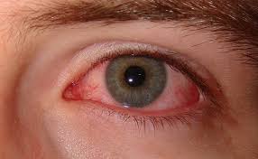 Ways to Care Your Eyesight: Different Symptoms of Red Eyes disease with ...