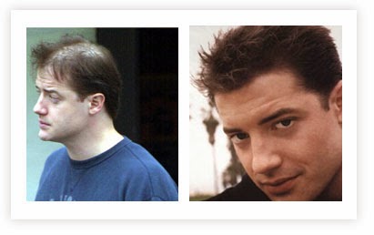 Brendan Fraser Hair Transplant