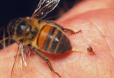 Bee Stings Allergy - Allergy Types