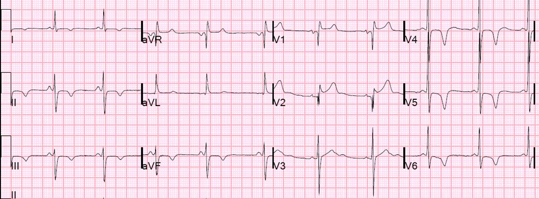 Dr. Smith's ECG Blog: ST elevation (Saddleback), is it STEMI?