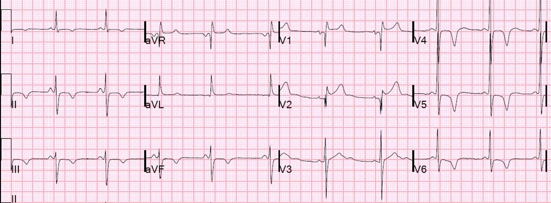 Dr. Smith's ECG Blog: ST elevation (Saddleback), is it STEMI?