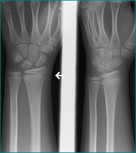 Lunate Dislocation Spilled Teacup