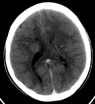 Grey matter heterotopia-MRI - Sumer's Radiology Blog