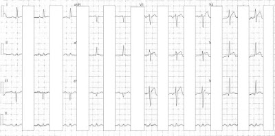 ECG of the Week: ECG of the Week - 1st February 2016 - Interpretation