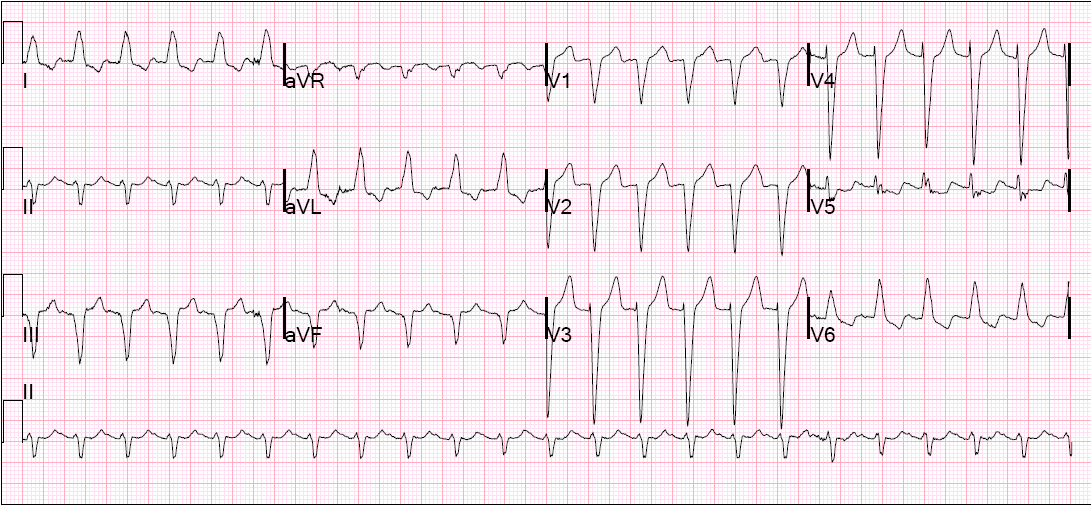 Dr. Smith's ECG Blog: Wide Complex Tachycardia: what is it?