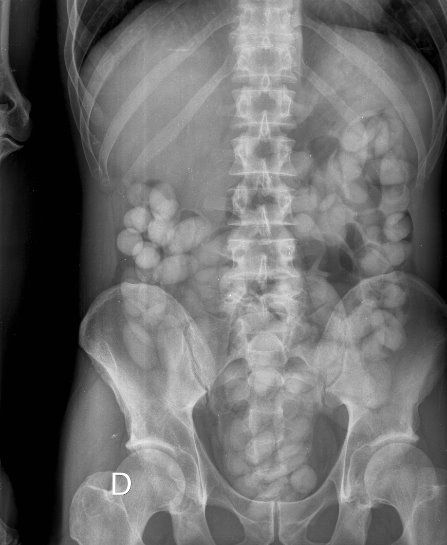 Sepsis Abdominal: 2015