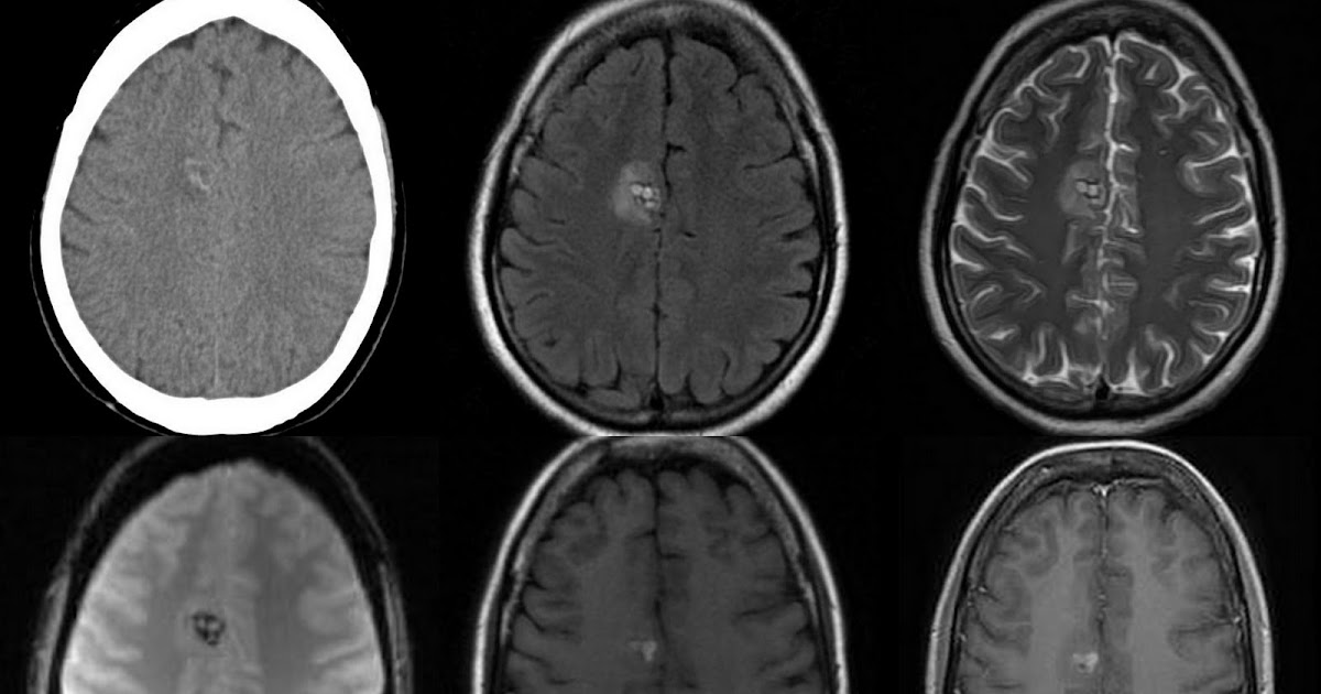 Neuroradiology Cases: Cavernoma (Cavernous Malformation)