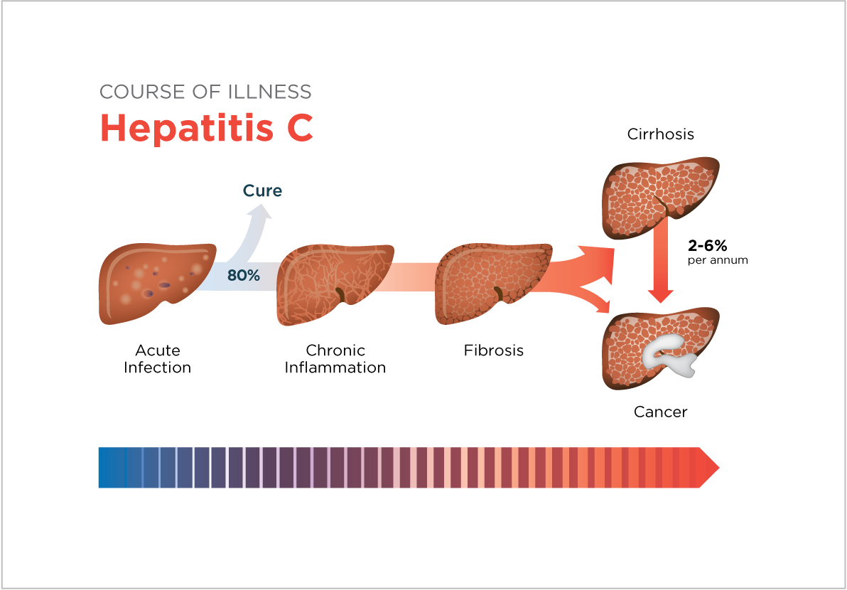 Pengertian Hepatitis, Gejala, Macam-macam Hepatitis dan Cara ...