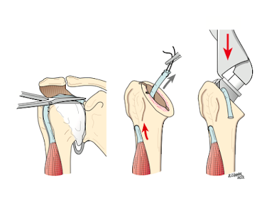 UW Shoulder and Elbow Academy: How we do a biceps tenodesis with ...