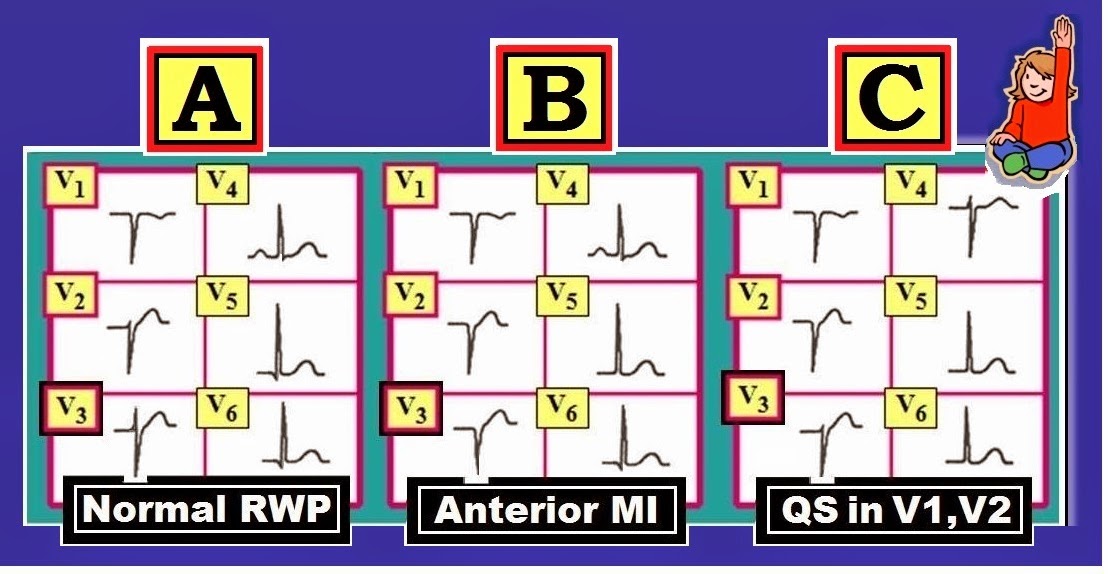 ECG Interpretation: ECG Blog #94 (Basic Concepts-7) – QRST Changes