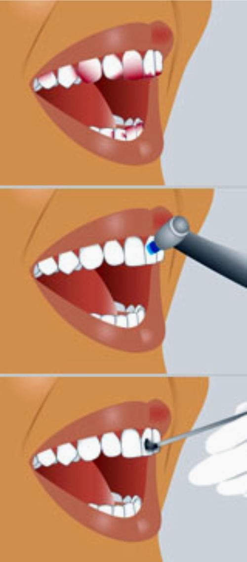 FORMA CORRECTA DE CEPILLARSE LOS DIENTES: PROFILAXIS DENTAL