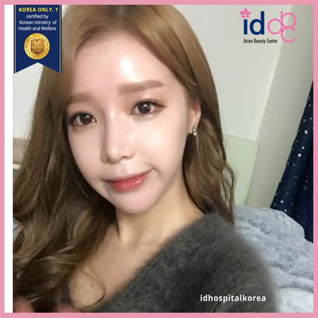 ID Hospital Korea: Korean girl after having two-jaw surgery at ID ...