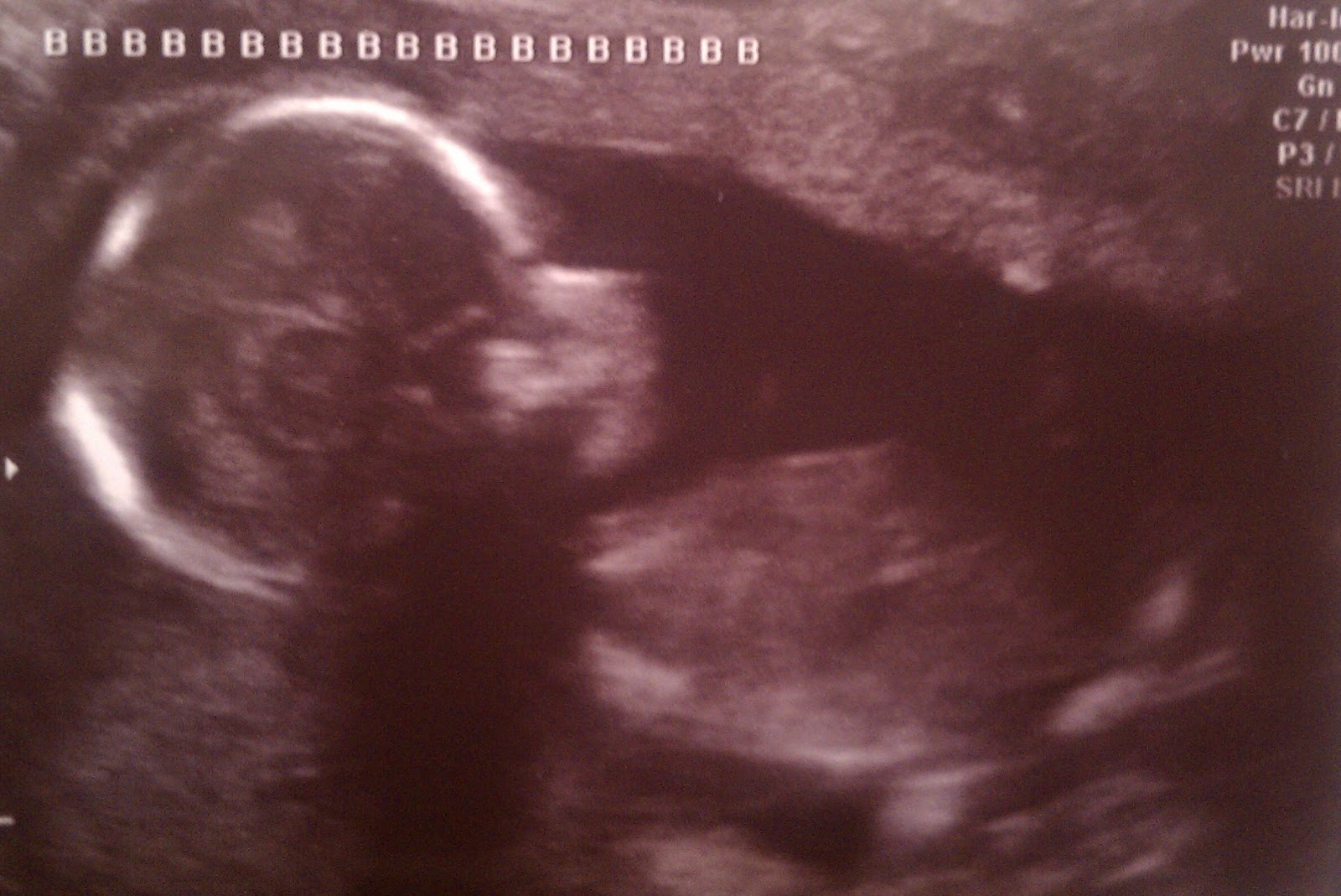 Red Fish, Blue Fish, We're Having a Third Fish!: 16 Week Ultrasound