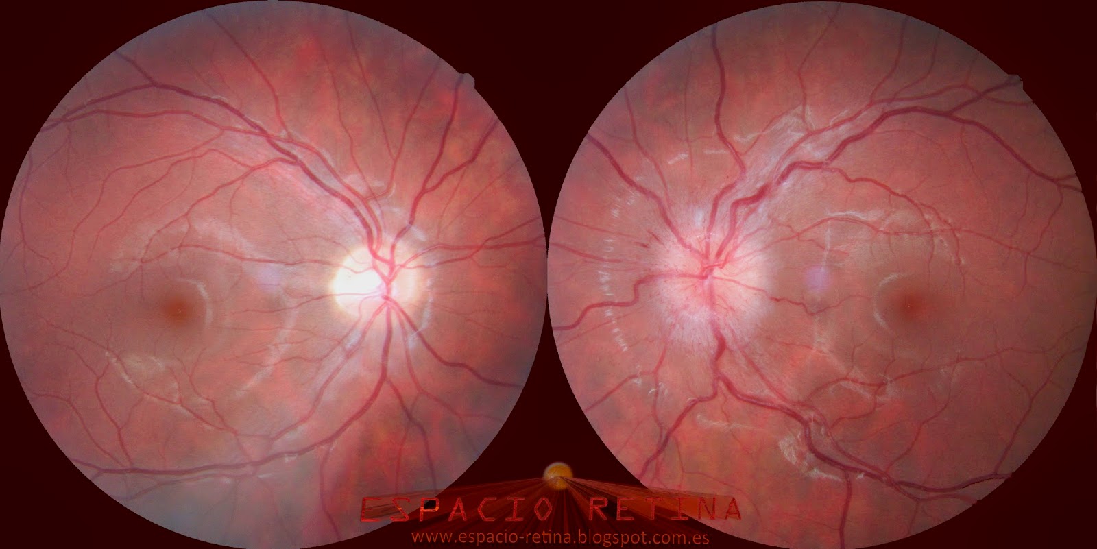 Papilitis / Neuritis óptica