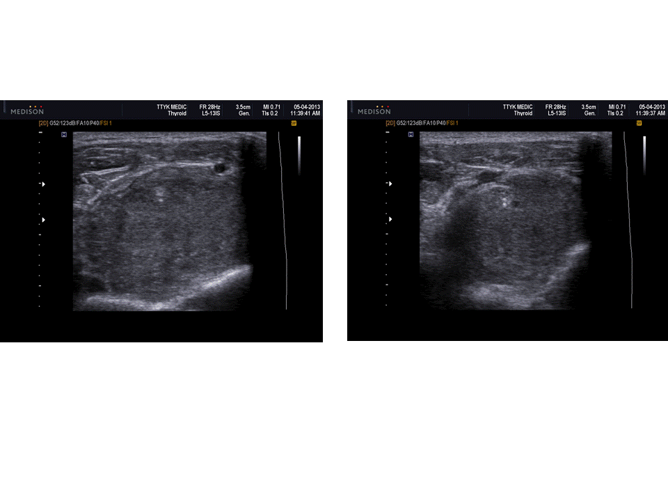 VIETNAMESE MEDIC ULTRASOUND: CASE 183: LEFT ARM MASS, Dr PHAN THANH HẢI ...