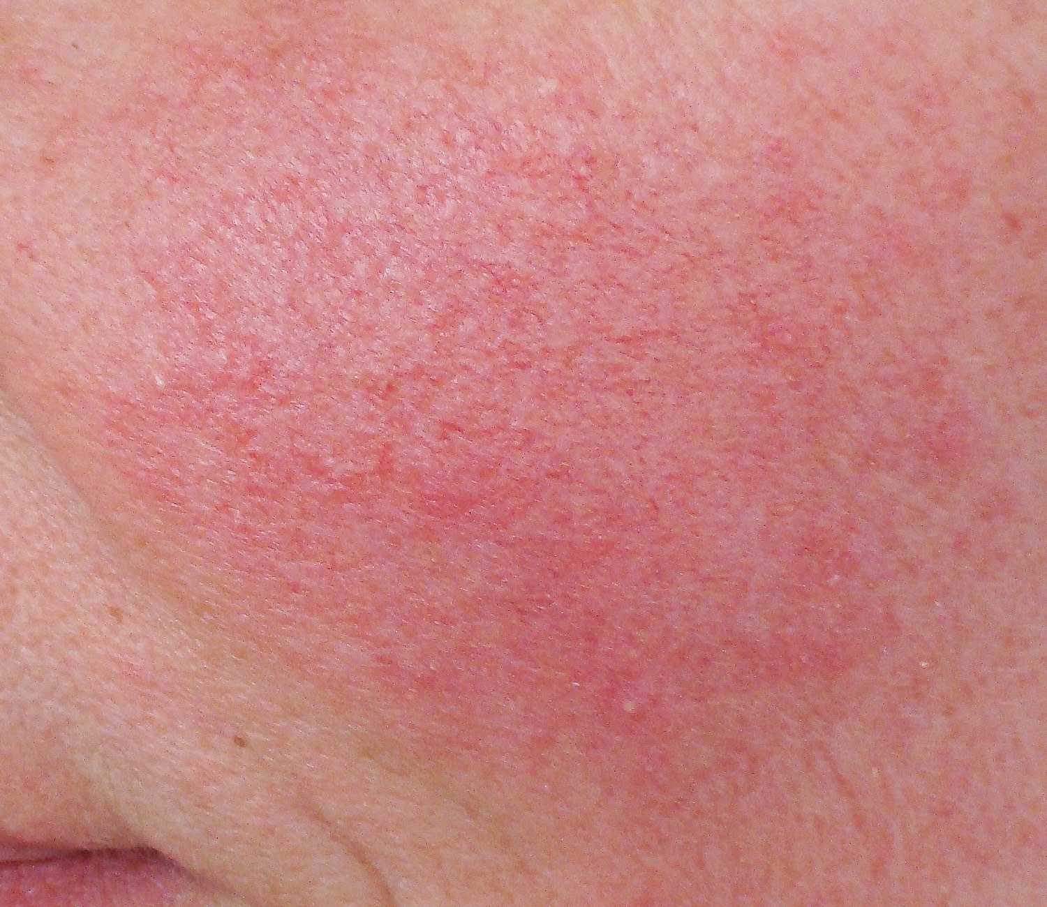 Boutons, rougeurs, vaisseaux... La rosacée, une maladie méconnue - Le ...