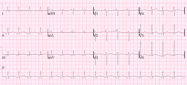 Sinus rhythm with ivcd meaning - leologix