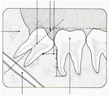 Dentistry and Medicine: Surgical management of Unerupted and Impacted teeth