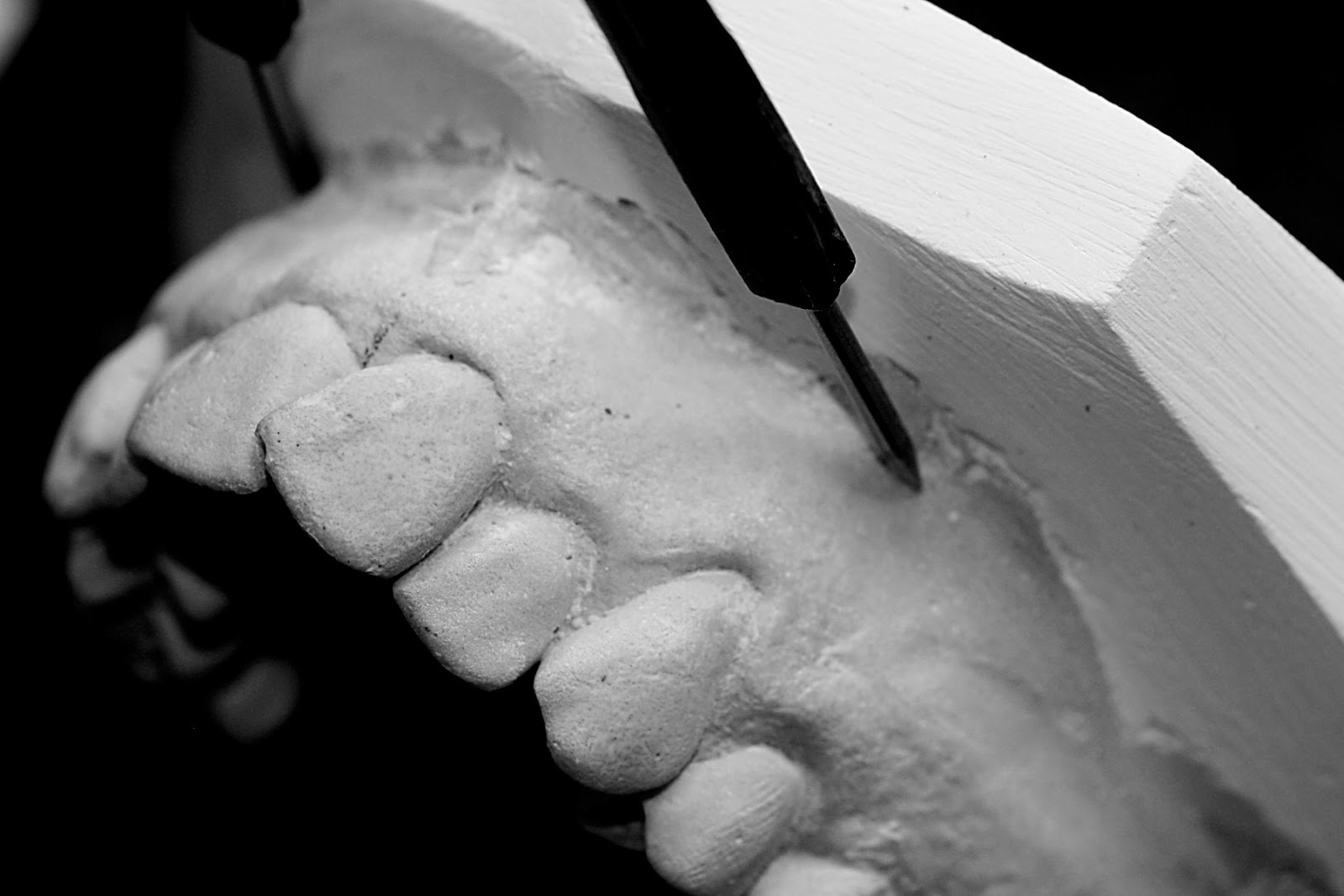 Orthodontics: UG Model analysis Ashley Howe's index