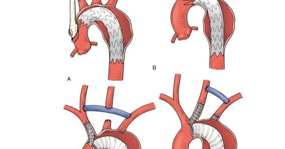 Vascular Mind : HYBRID DEBRANCHING OF THE ARCH VESSELS DURING TEVAR.