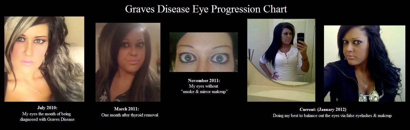 I FEEL DELICIOUS: Graves Disease: An Interview with Rayanne Forbes