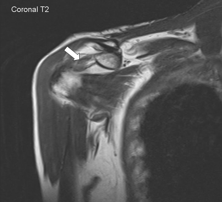 mricases: Adhesive Capsulitis - Frozen Shoulder - MRI features
