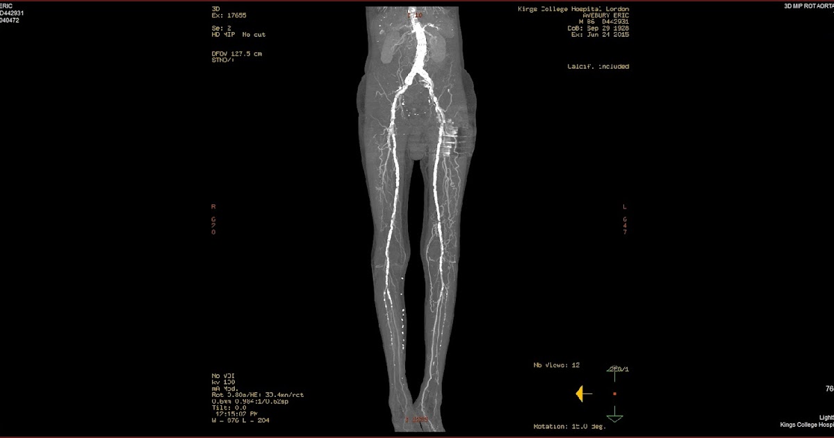 Eric Avebury: Angiogram of legs, taken before angioplasty