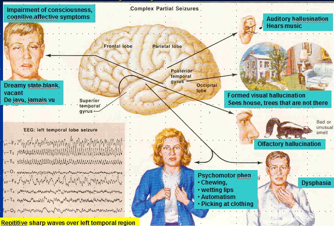 PUBLIC HEALTH: CLINICAL ASPECT OF PARTIAL EPILEPSY