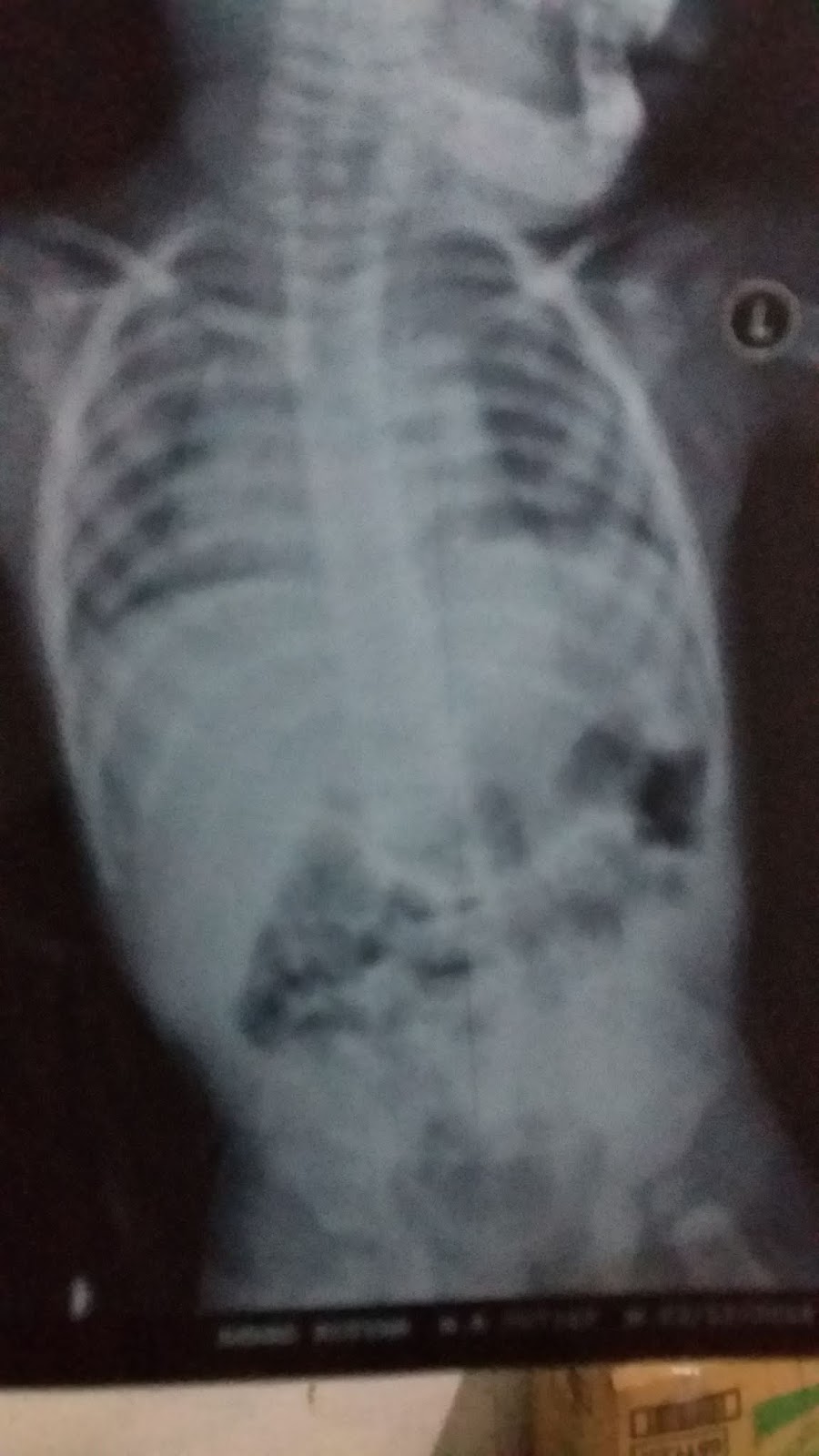 Contoh Laporan Hasil Radiologi Diagnosis TB Kelenjar pada Anak