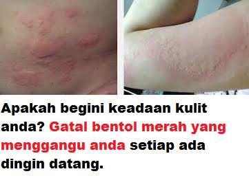 Obat Biduran: Biduran Penyebab Gejala Dan Pengobatan