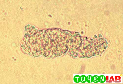 Atlas of Casts in urine | Free Medical Atlas