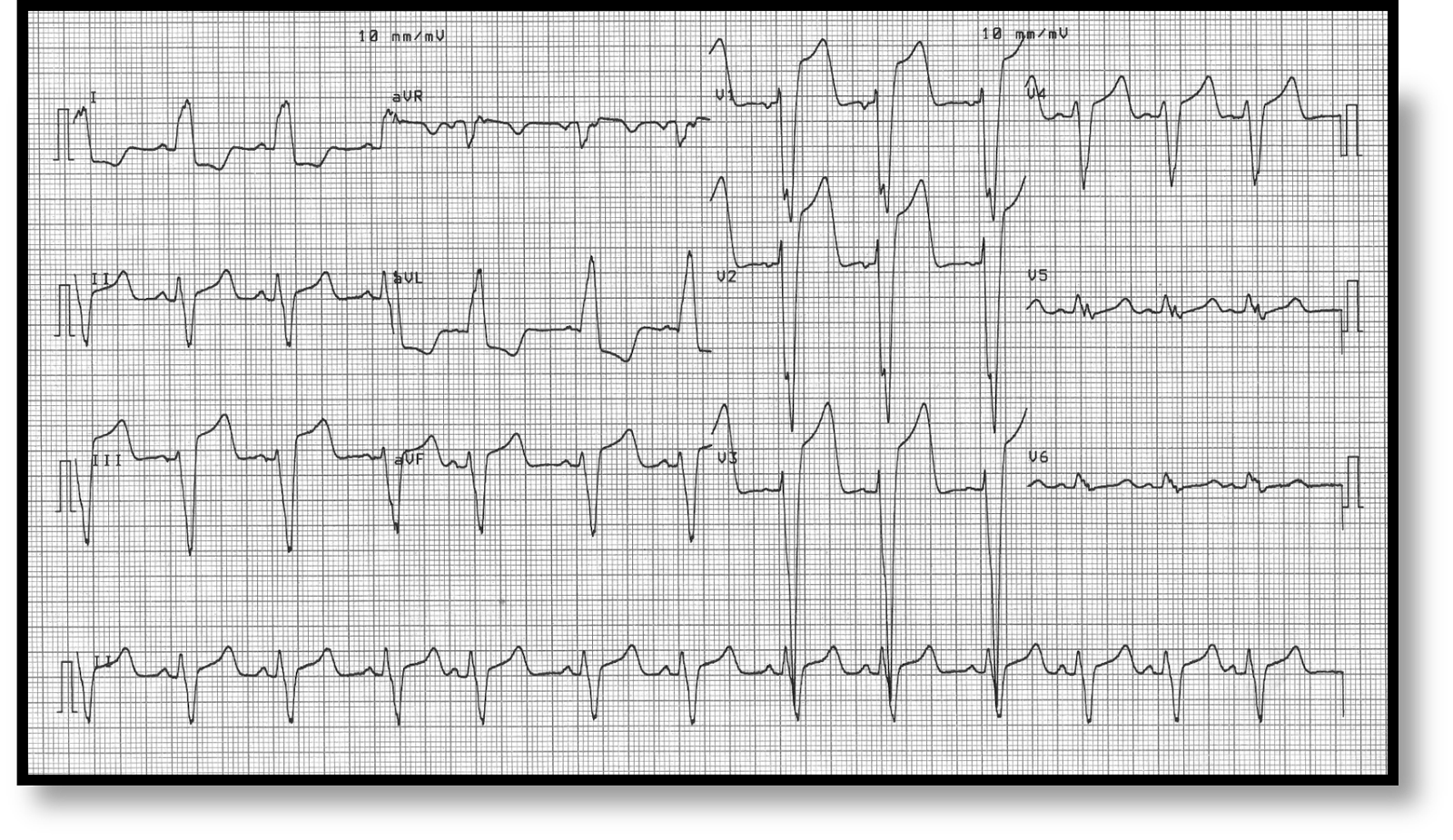 Andrew R. Houghton: Sgarbossa criteria: How to diagnose myocardial ...