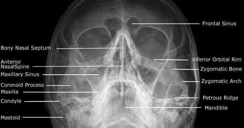 Diagnostic Medical Imaging : Waters' view - X-ray Paranasal sinuses
