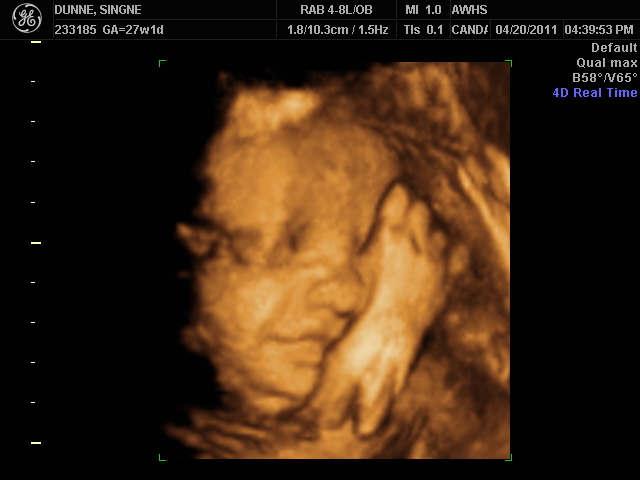 The Dunne Family: 3D Ultrasound Pictures 28 weeks