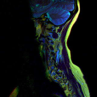Nevit's blog: Cervical spine Color MRI