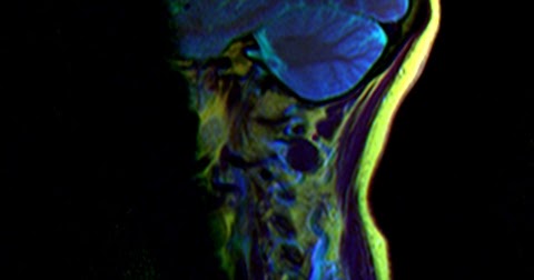 Nevit's blog: Cervical spine Color MRI