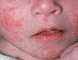 Neonatal Seborrheic Dermatitis