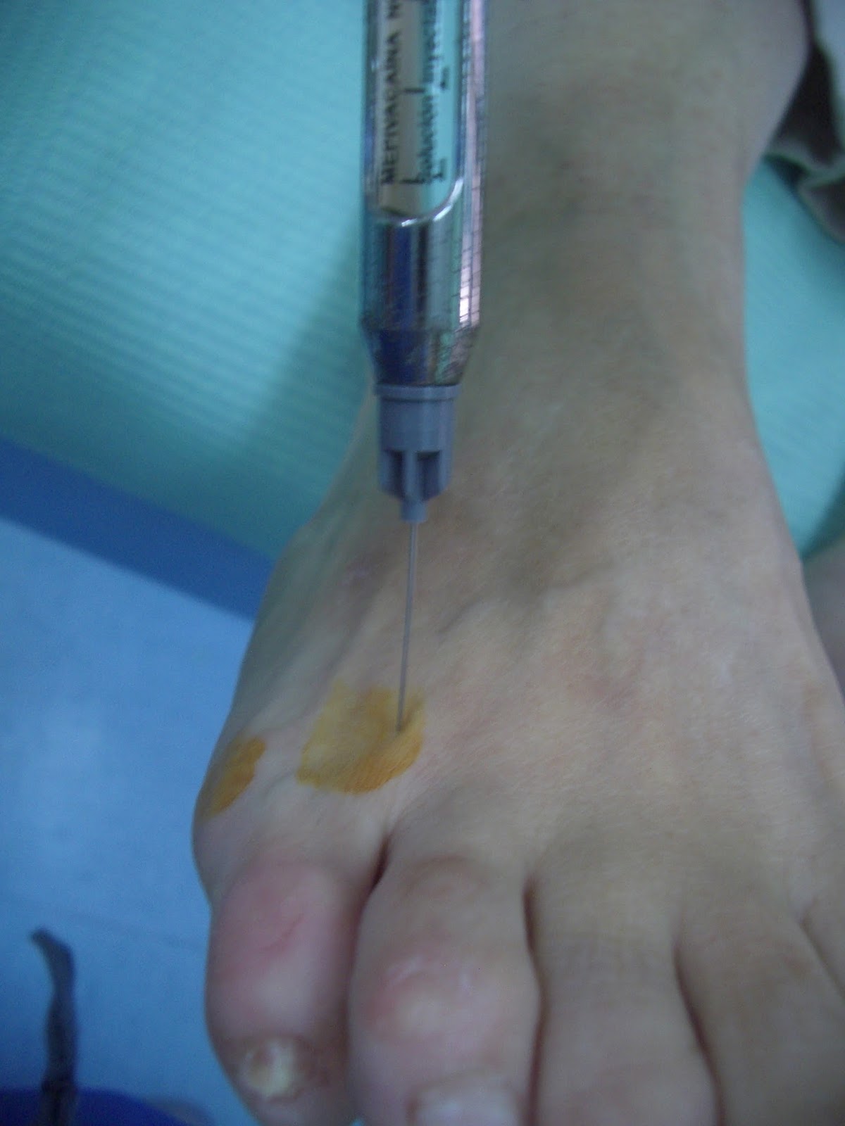 Podo Basas al Día: Operación de heloma interdigital. Operación de ojo ...