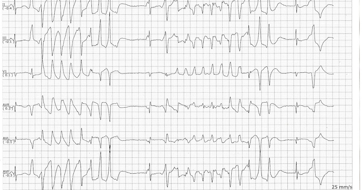 Polymorphic ventricular tachycardia